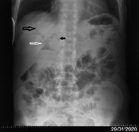 Abdominal Xray Showing Extensive Bilobar Pneumobilia with Clear ...
