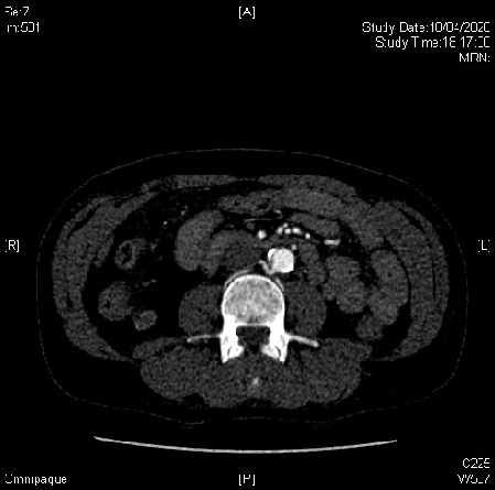 Life Threatening Cause of Right Flank Pain